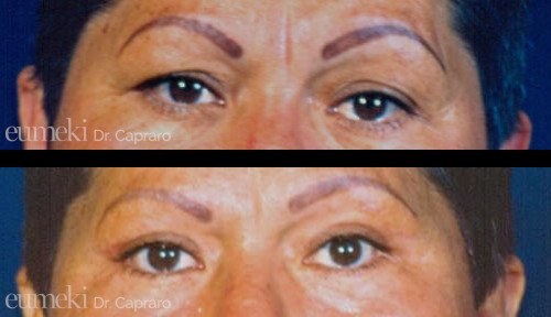 Blefaroplastica - Dottor Capraro